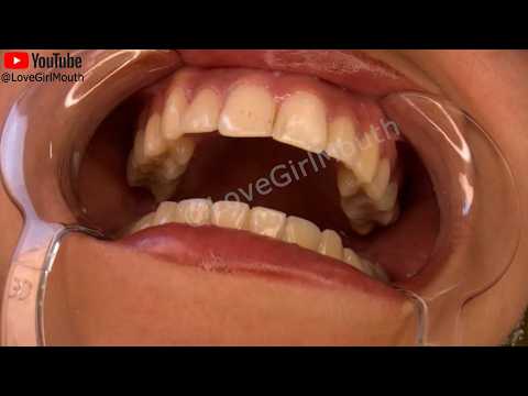 Girl mouth tour shows her great teeth Girl uses a mouth opener, mouth spreader to show her teeth