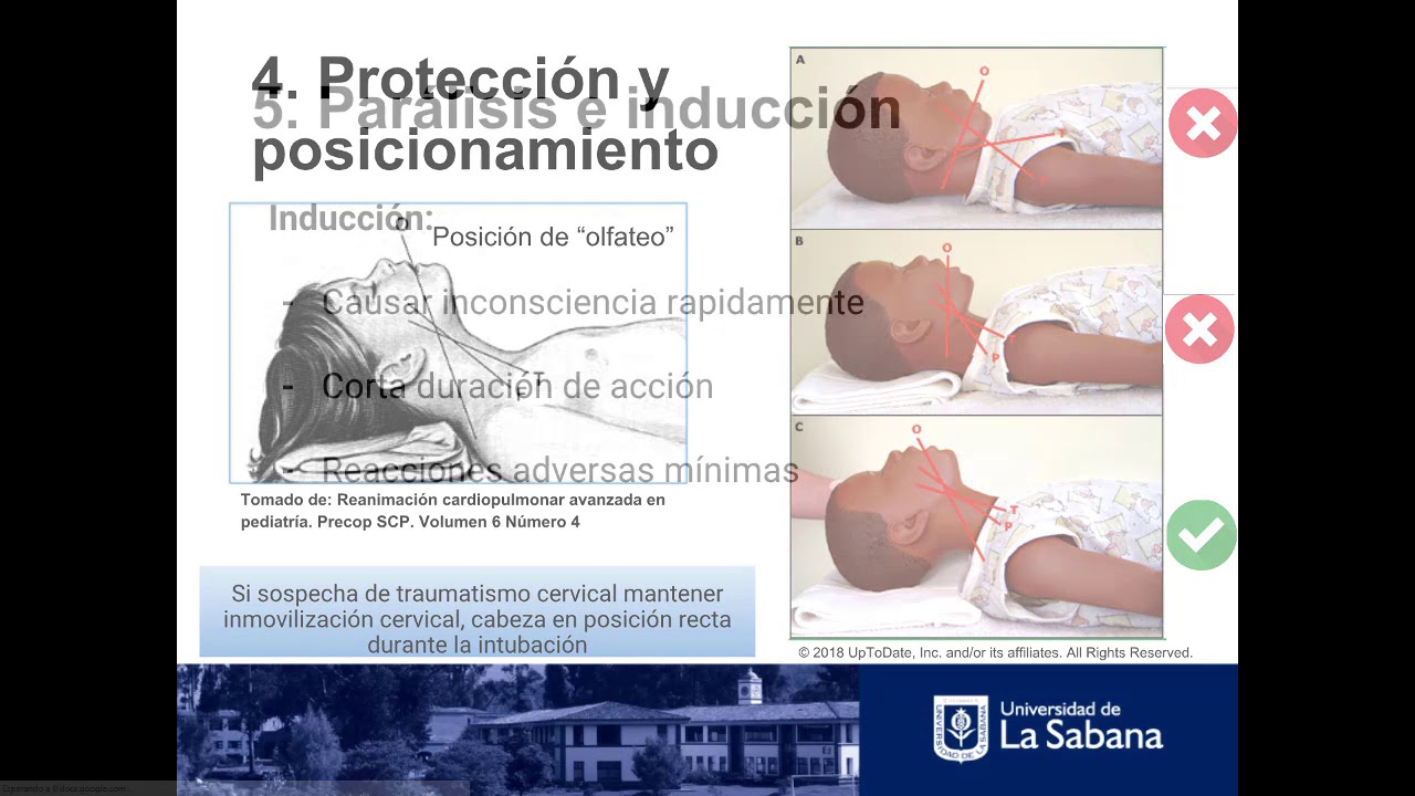 Secuencia de intubación rápida en pediatría - YouTube