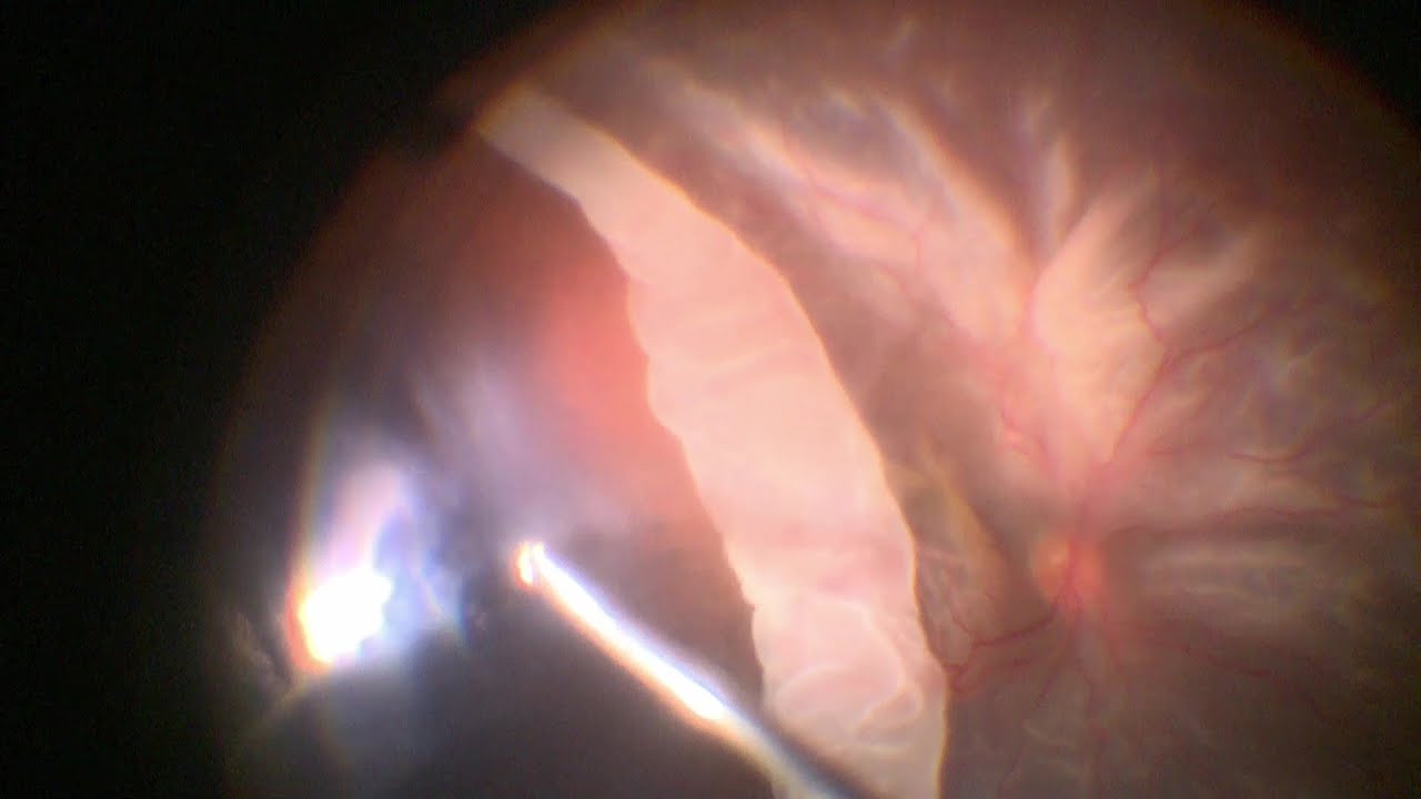 Vitrectomy for Giant Retinal Tear | Retained PFCL 2 step procedure ...