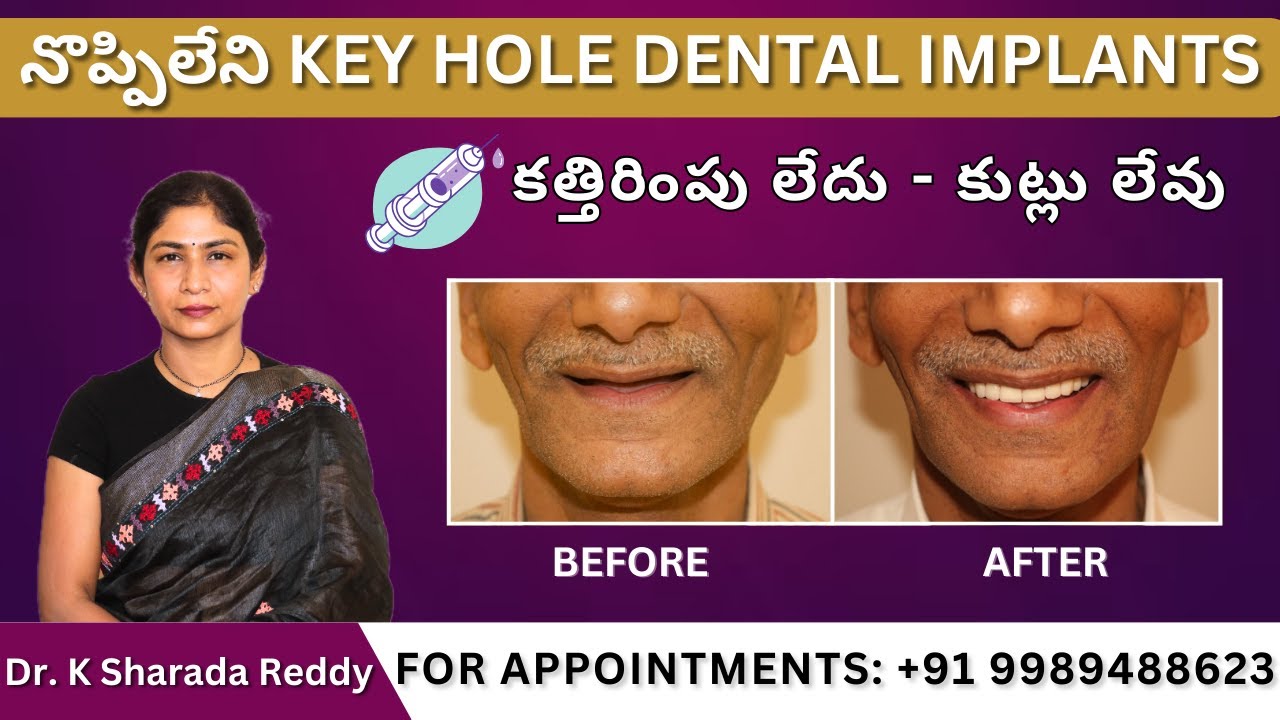నొప్పిలేని KEY HOLE DENTAL IMPLANTS || కత్తిరింపు లేదు - కుట్లు లేవు ...