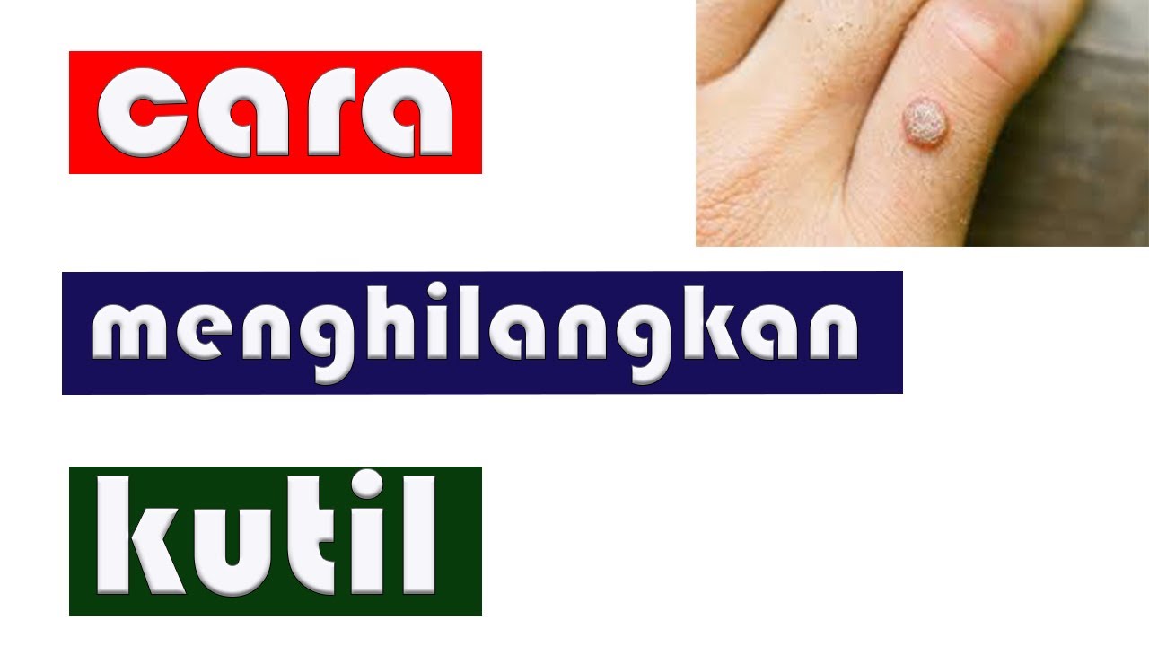 CARA MENGHILANGKAN KUTIL - YouTube
