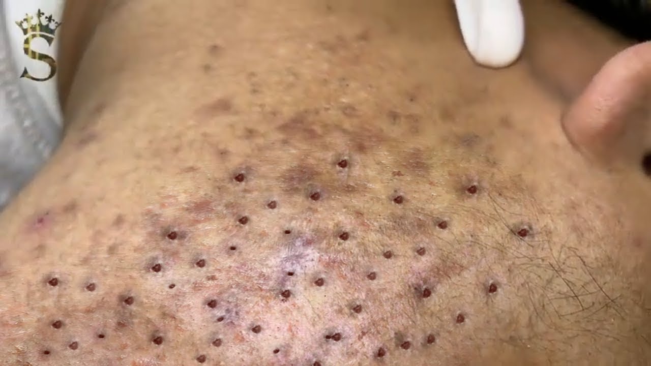 Big Cystic Acne Blackheads Extraction Blackheads & Milia, Whiteheads ...