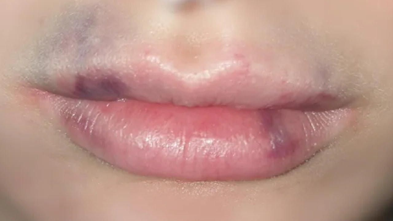 how to get rid of bruised lips in only a few minutes - YouTube