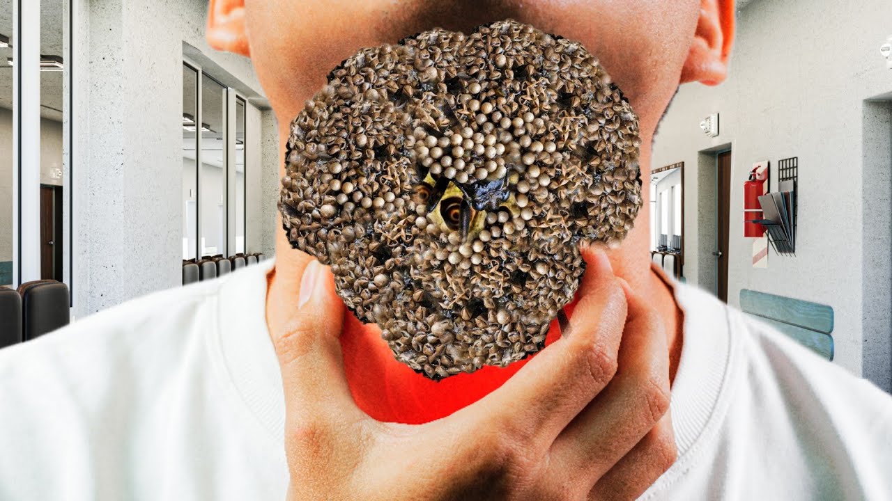 ASMR removal insect & Tick infected neck | ASMR neck surgery treatment ...