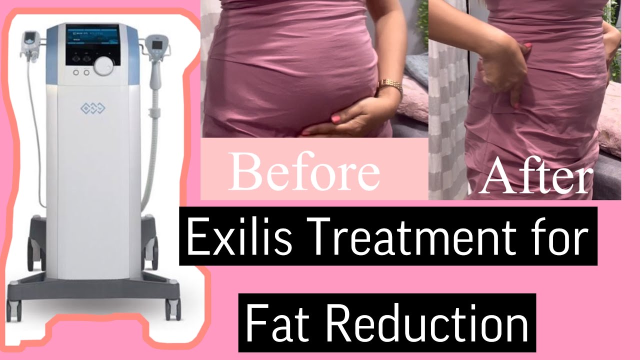 I tried Exilis Treatment and 1” fat gone for a 35 Minutes Session - YouTube
