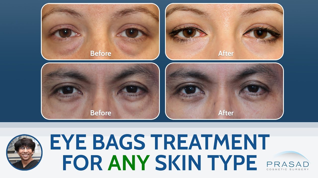 Treating Under Eye Bags in Any Skin Type - YouTube