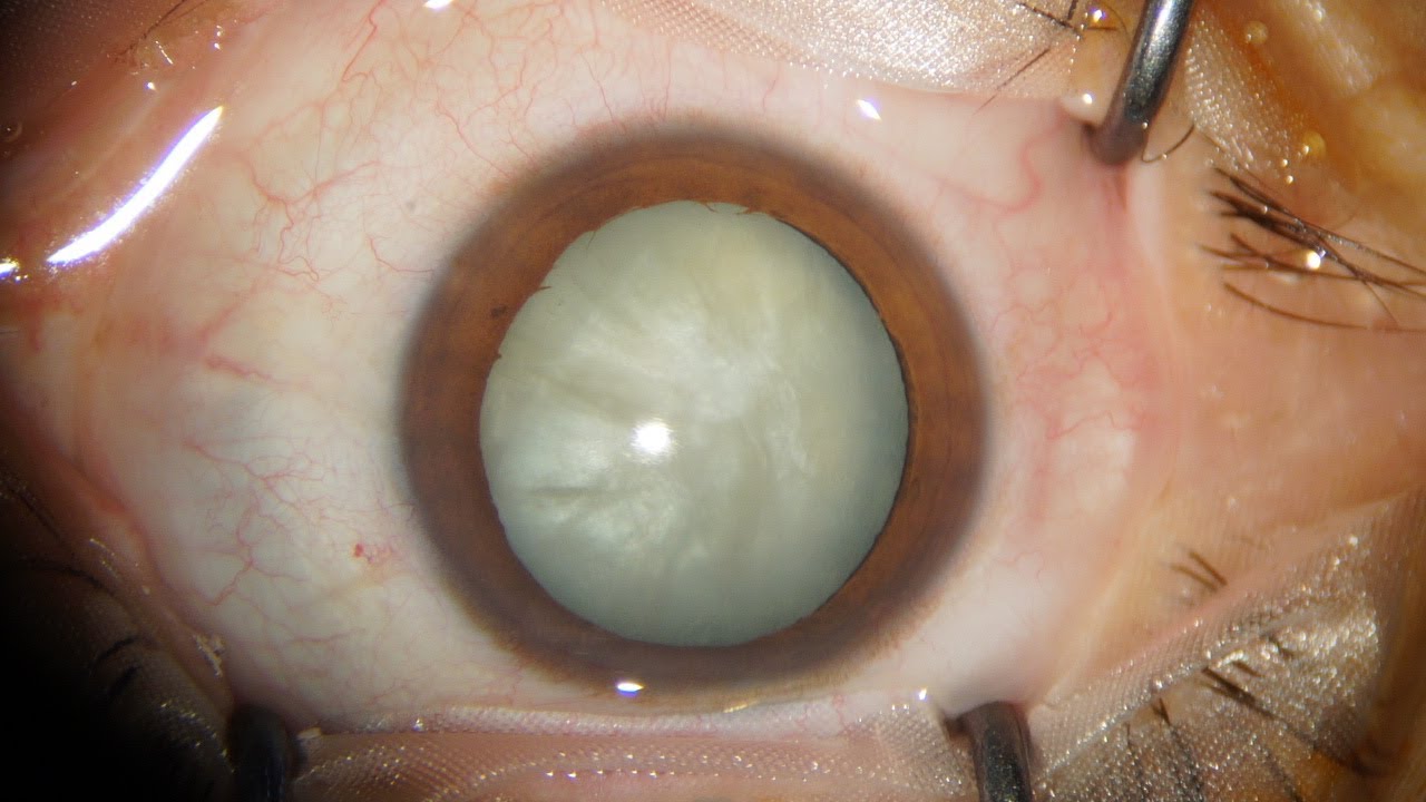 THE GREAT WHITE CATARACT - YouTube
