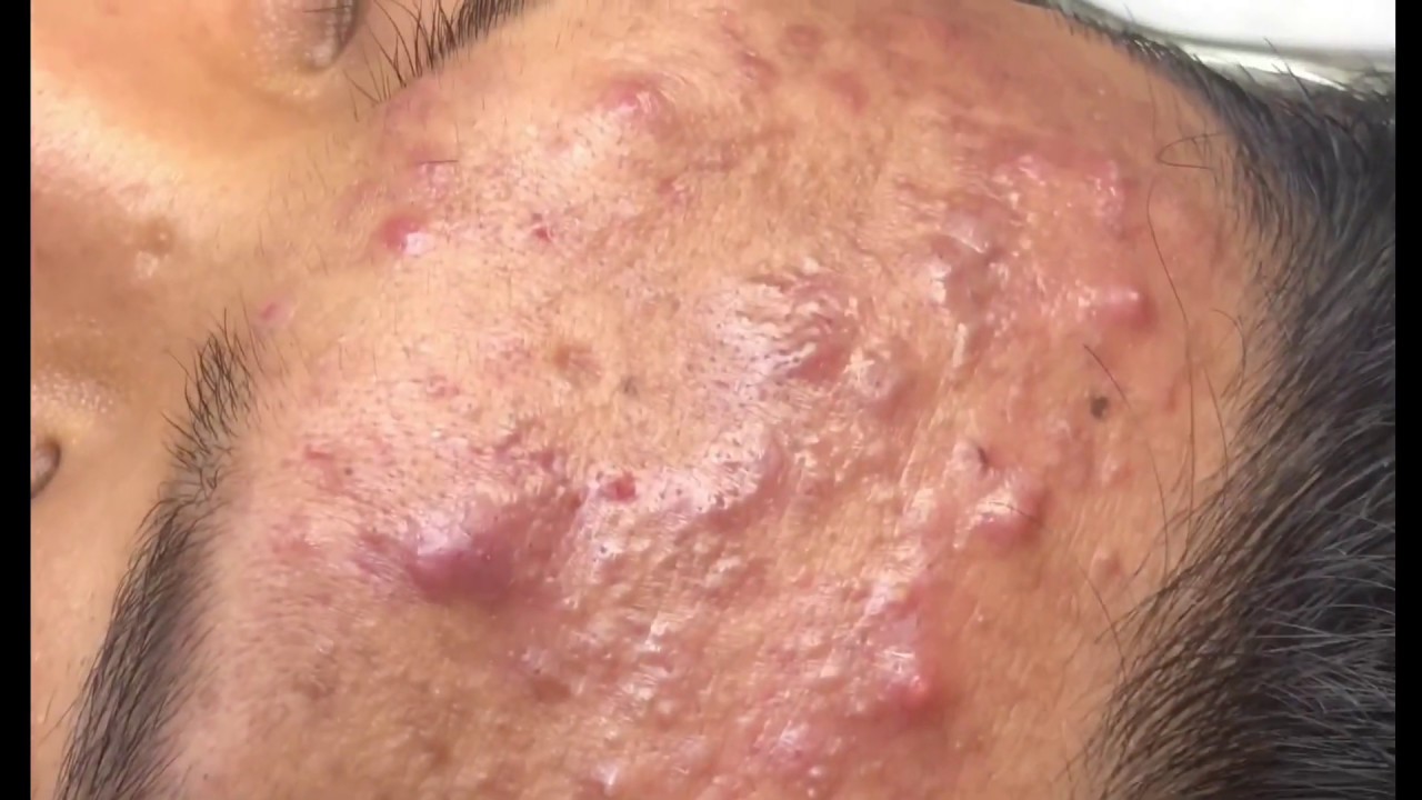Horror Acne EP4 - YouTube