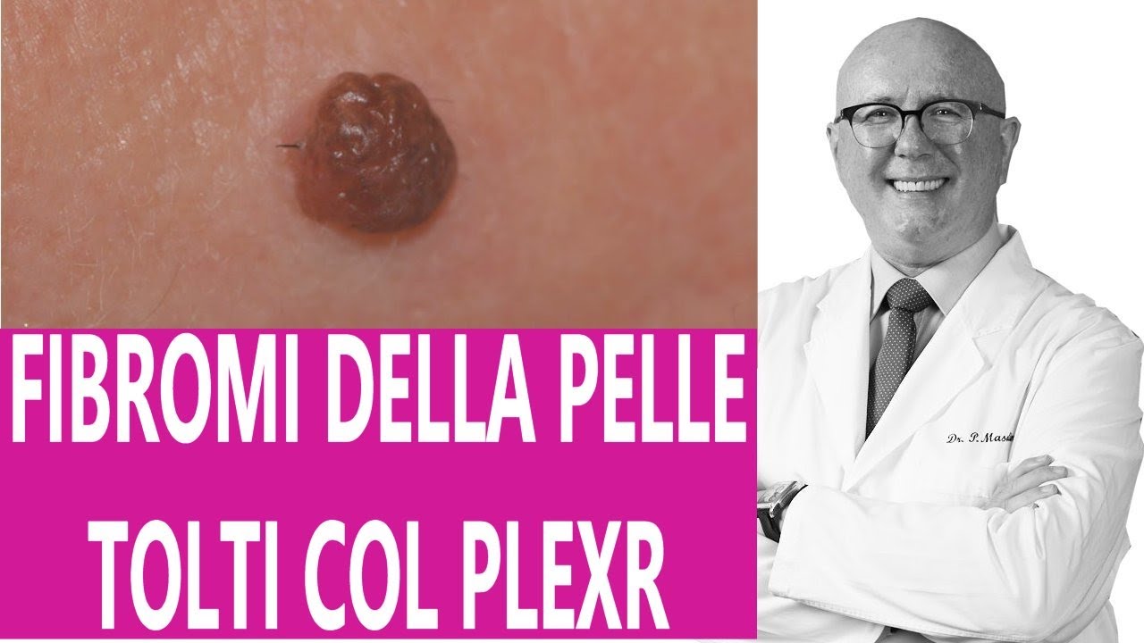 Eliminare i fibromi della pelle del viso ed altre formazioni col PLEXR ...
