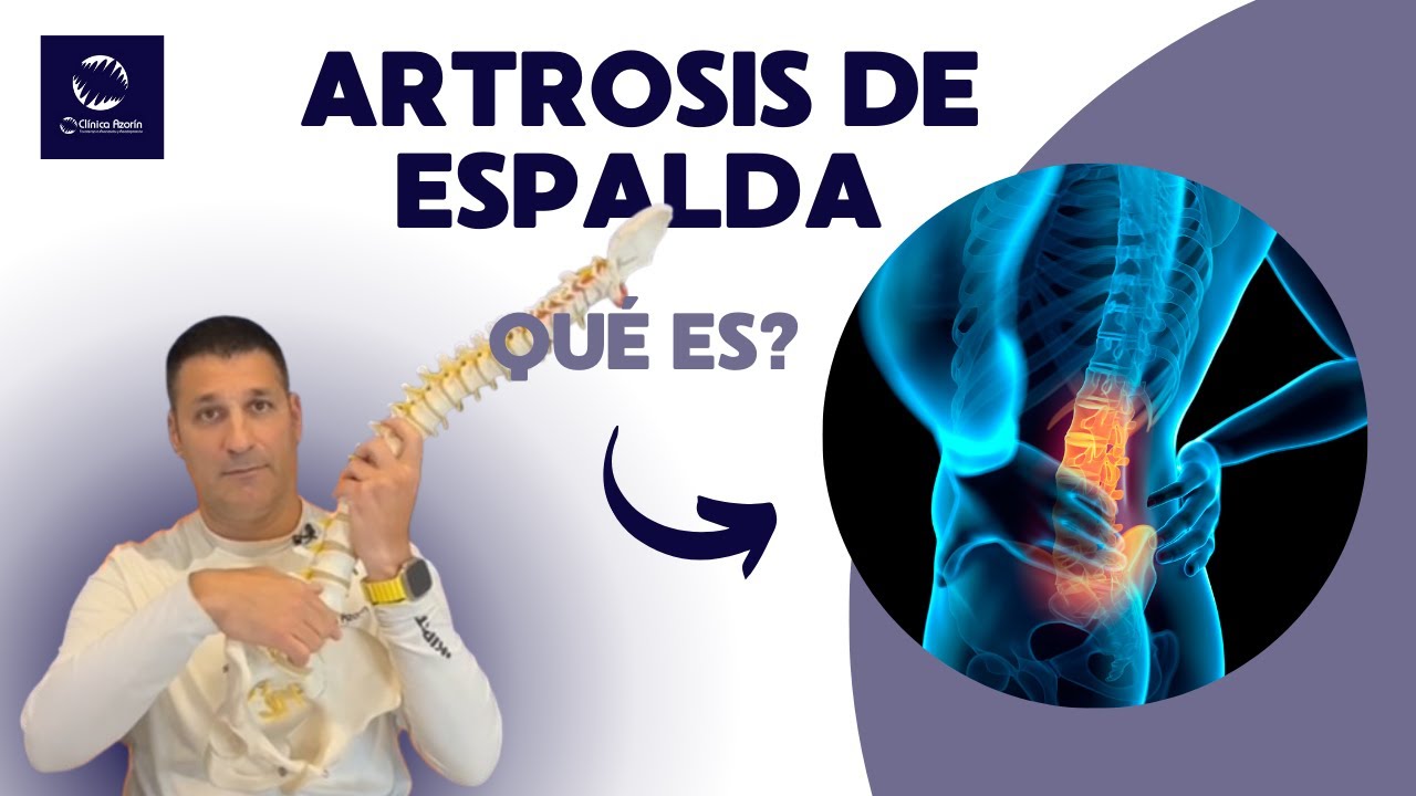 Si tienes estos 3 síntomas, puedes sufrir artrosis de espalda - YouTube