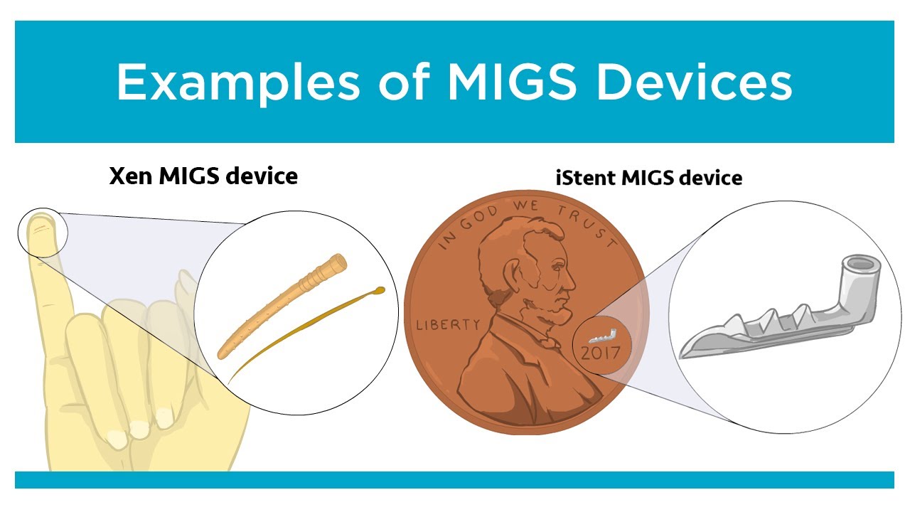 Innovations in Glaucoma Treatment: MIGS - YouTube