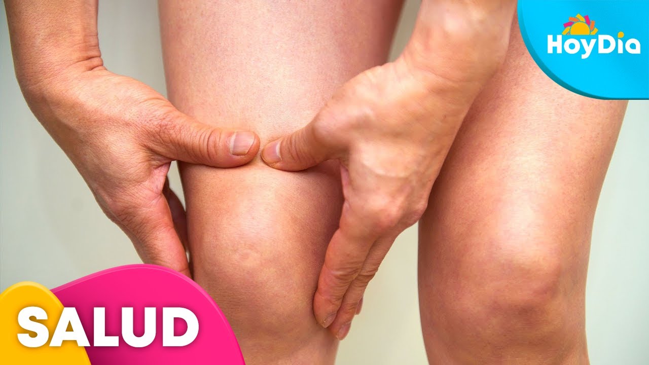 ¿Qué problemas de salud causan las piernas hinchadas? | Hoy Día ...