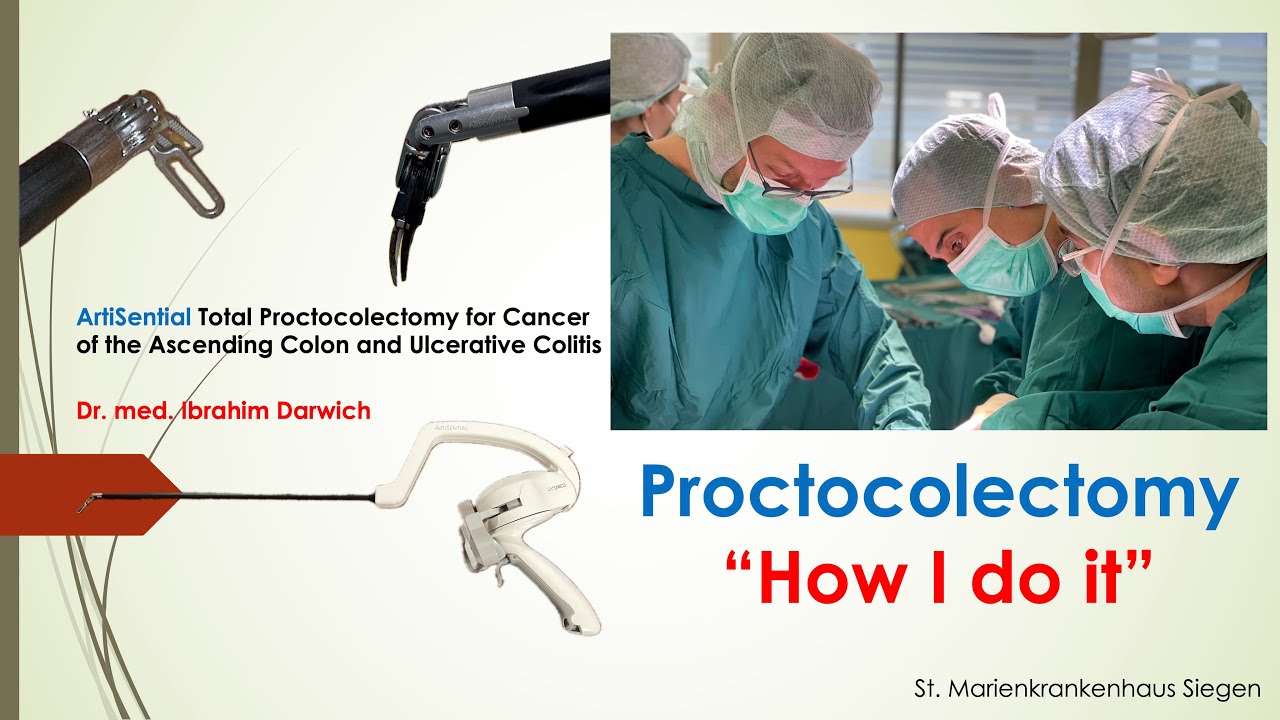 #ArtiSential assisted total proctocolectomy for Colon Cancer and ...