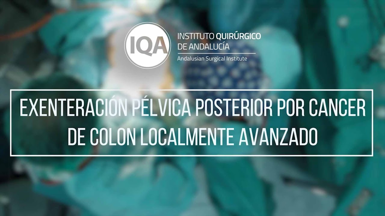 Exenteración pélvica posterior por cáncer de colon localmente avanzado ...