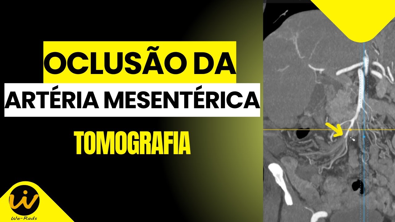 OCLUSÃO da ARTÉRIA MESENTÉRICA com SOFRIMENTO Intestinal - YouTube