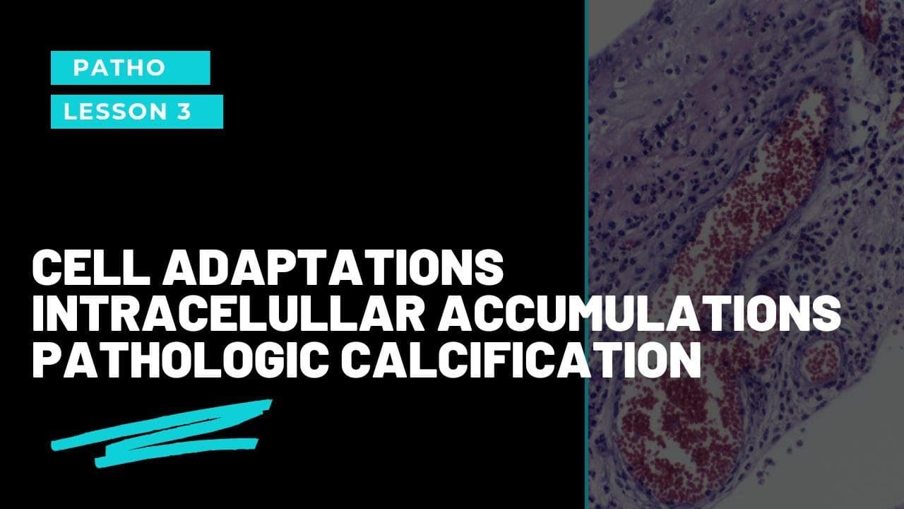 Cell Adaptations, Intracellular Accumulations, Pathologic Calcification ...