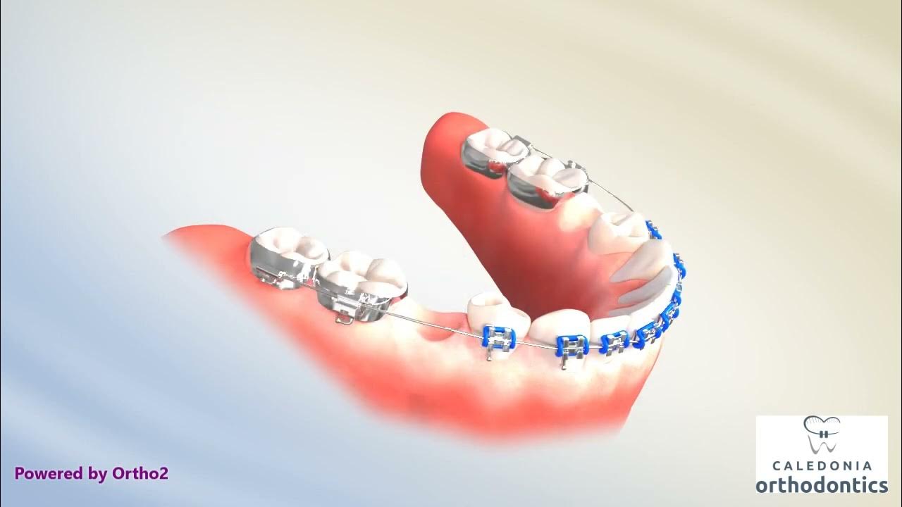 Lower premolar extractions to treat Class III malocclusion - YouTube