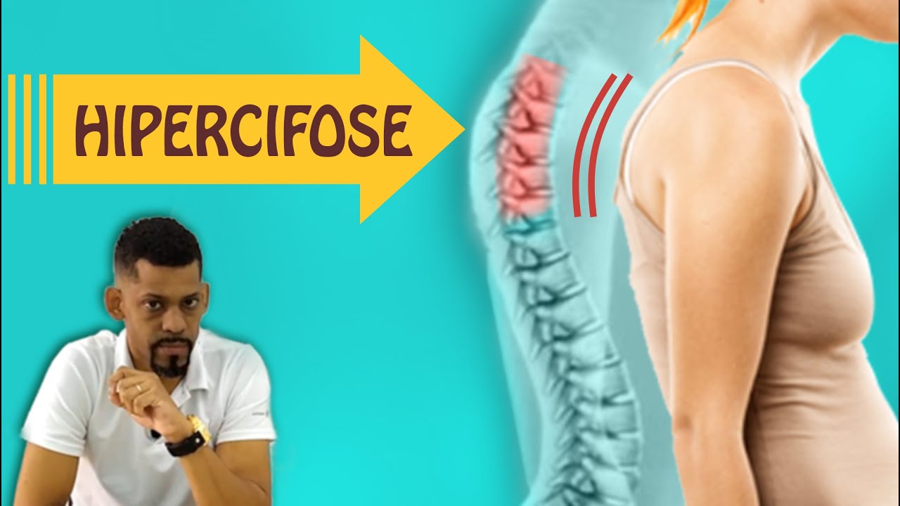 Hipercifose Torácica - O que é? | Vídeo c/ exercícios p/ EVITAR A ...