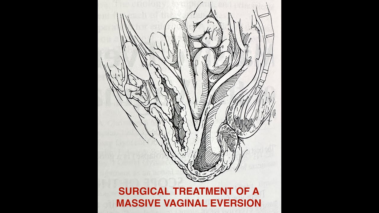 MASSIVE VAGINAL EVERSION (VAULT PROLAPSE) HD 720p - YouTube