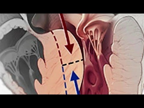 Beyond the horizons.... Transventricular & Transapical Septal Myectomy ...