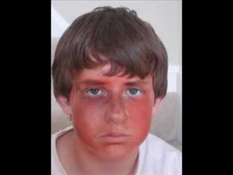 The Worst Sunburn Ever - YouTube