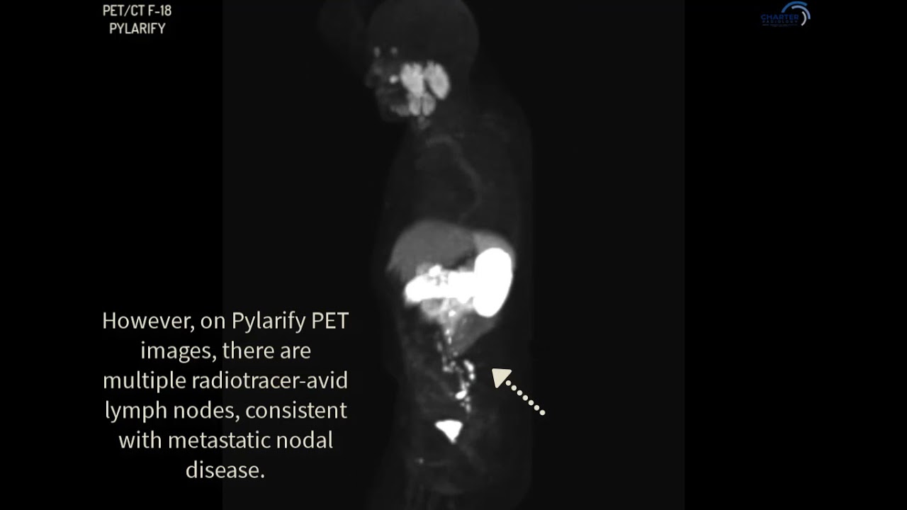 PSMA PET/CT PYLARIFY Case 2 - YouTube