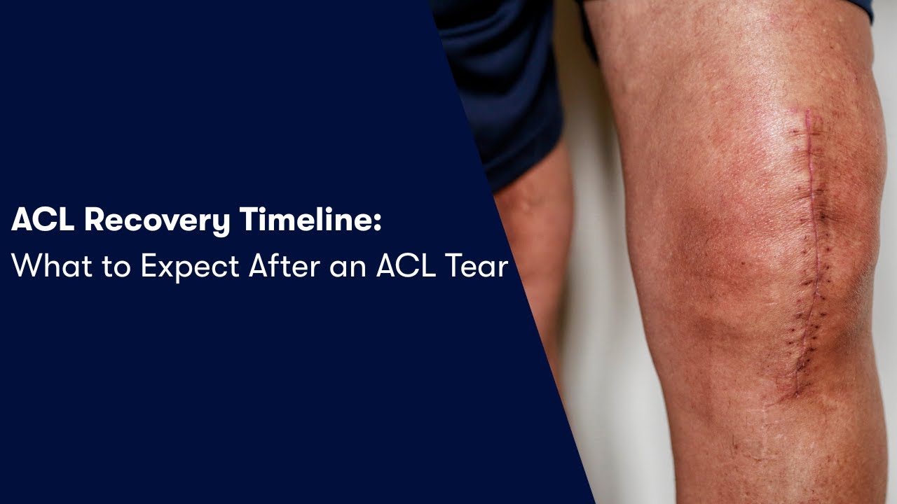 ACL Recovery Timeline: What to Expect After an ACL Tear | Physical ...