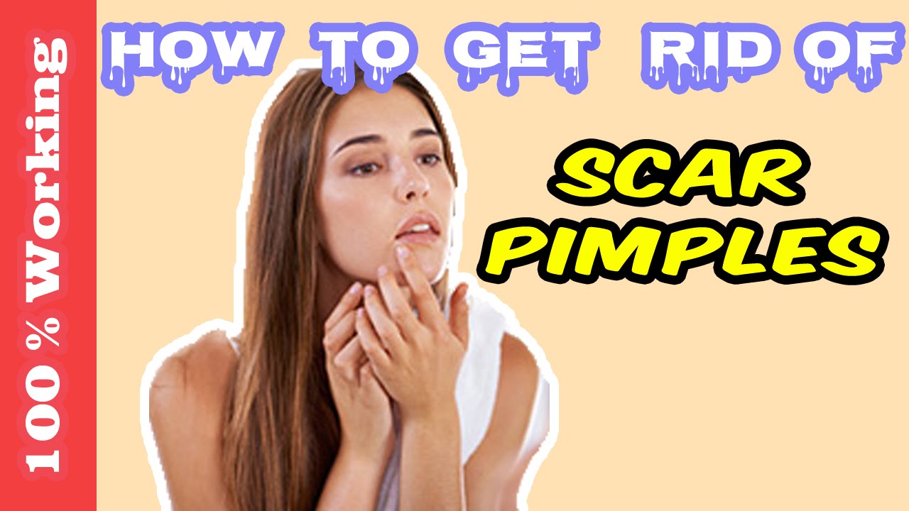 How To Get Rid Of Acne Scars Overnight Fast Home Remedies how-to-get-rid-of-acne-scars-overnight-fast-home-remedies