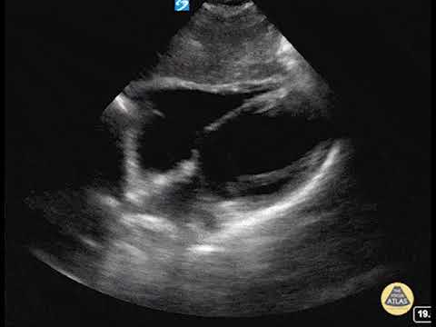 Normal Subxiphoid View - YouTube