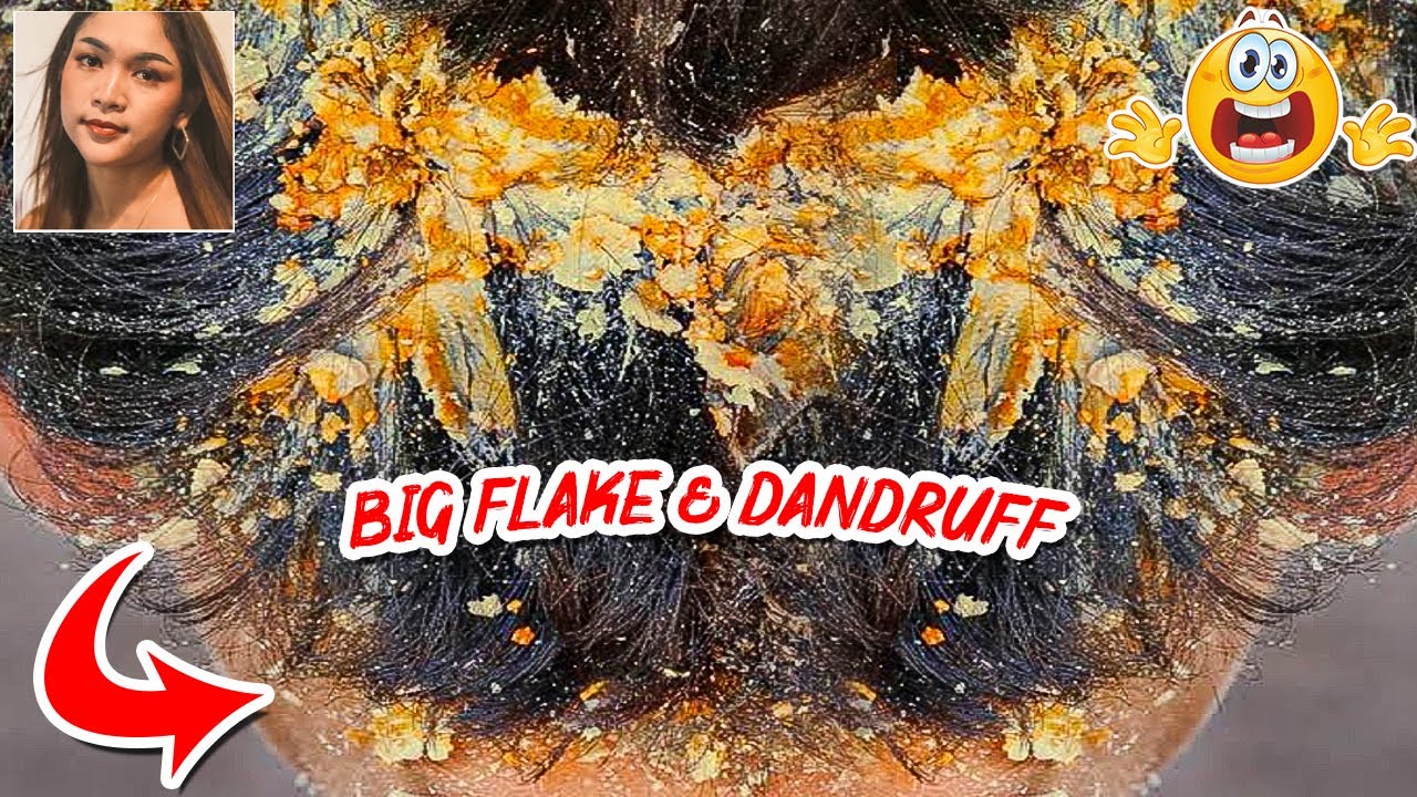 The Big Flakes !! Huge Dandruff In My Scalp Removal Use Lice Combing ...