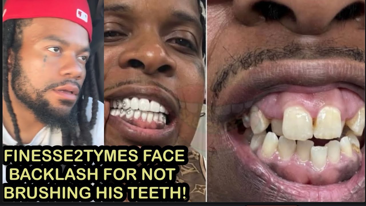 FINESSE2TYMES SAYS HE DIDNT BRUSH HIS TEETH BEFORE GETTING THEM FIXED ...