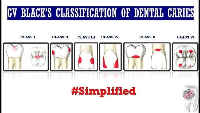 Dental Caries Classification