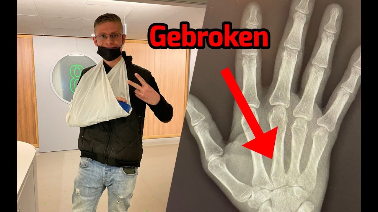 IK HEB MIJN HAND GEBROKEN!!! #32 - YouTube