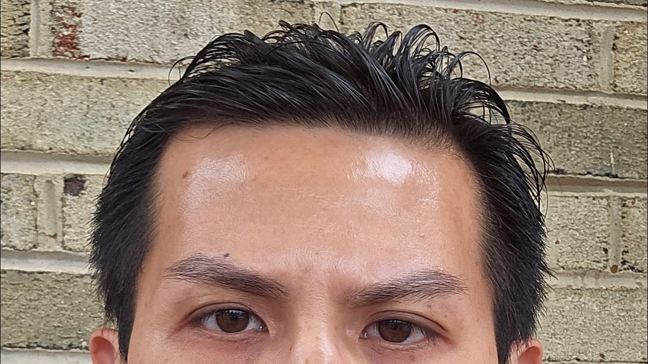 How To Get a Straight Hairline. Crooked Hairline Correction. Now ...