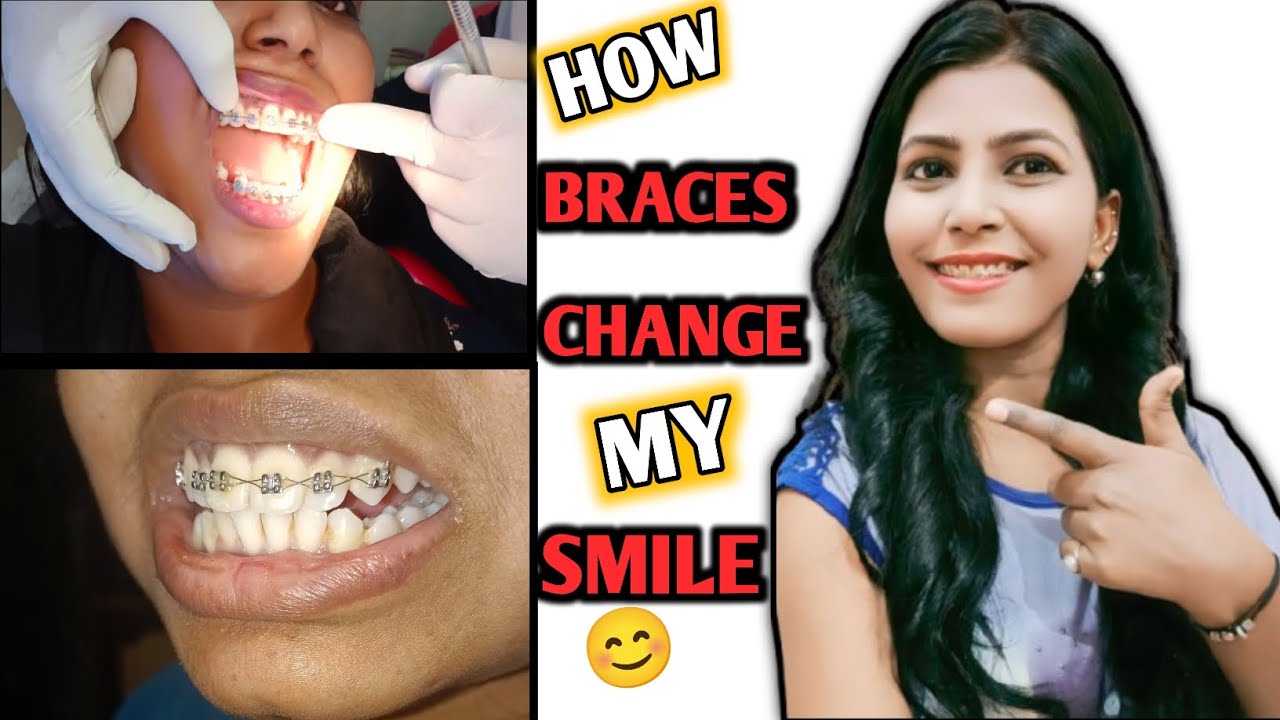 Teeth Braces Before And After Face Change || How Braces Change My Smile ...