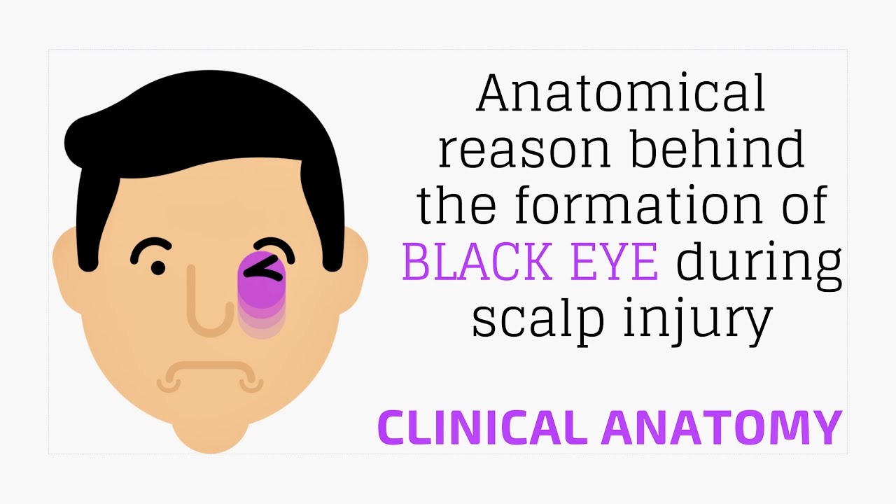 Black Eye, Anatomical Reason, Important question for anatomy exam # ...