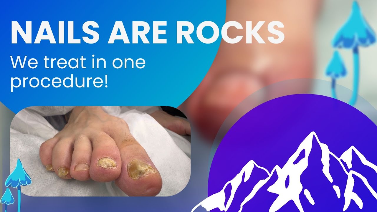 NAILS ARE ROCKS. NAIL FUNGUS AND OPEN SHOES. WE TREAT IT IN ONE ...