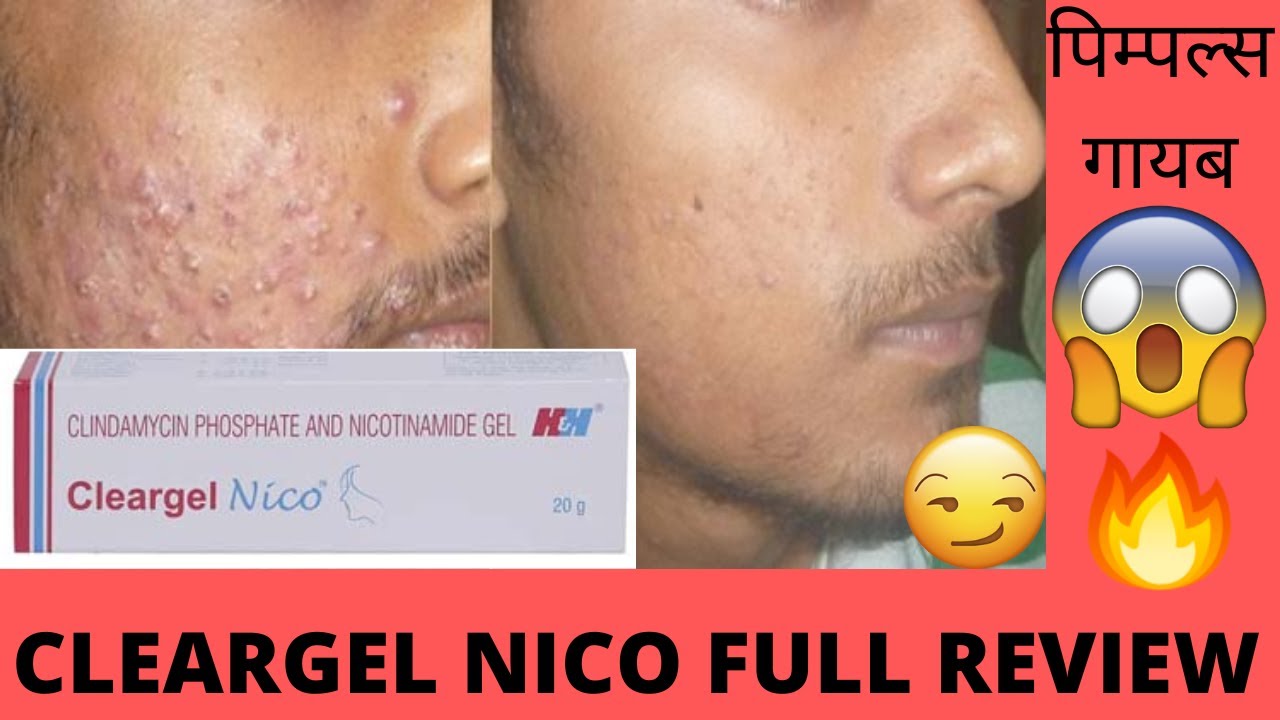 Bye-Bye Acne Woes! Cleargel Nico Gel Review |स्पष्ट और चमकदार त्वचा की ...