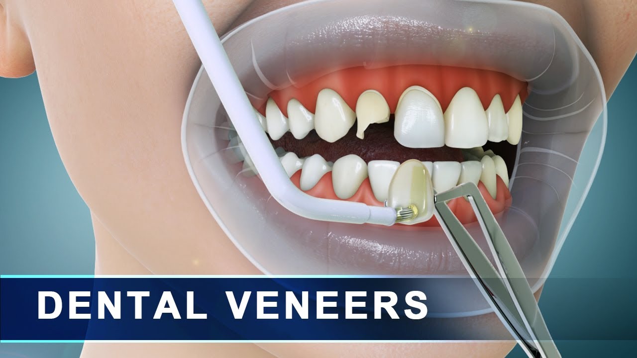 Veneers | Step by step preparation and placement of dental veneers | 3d ...