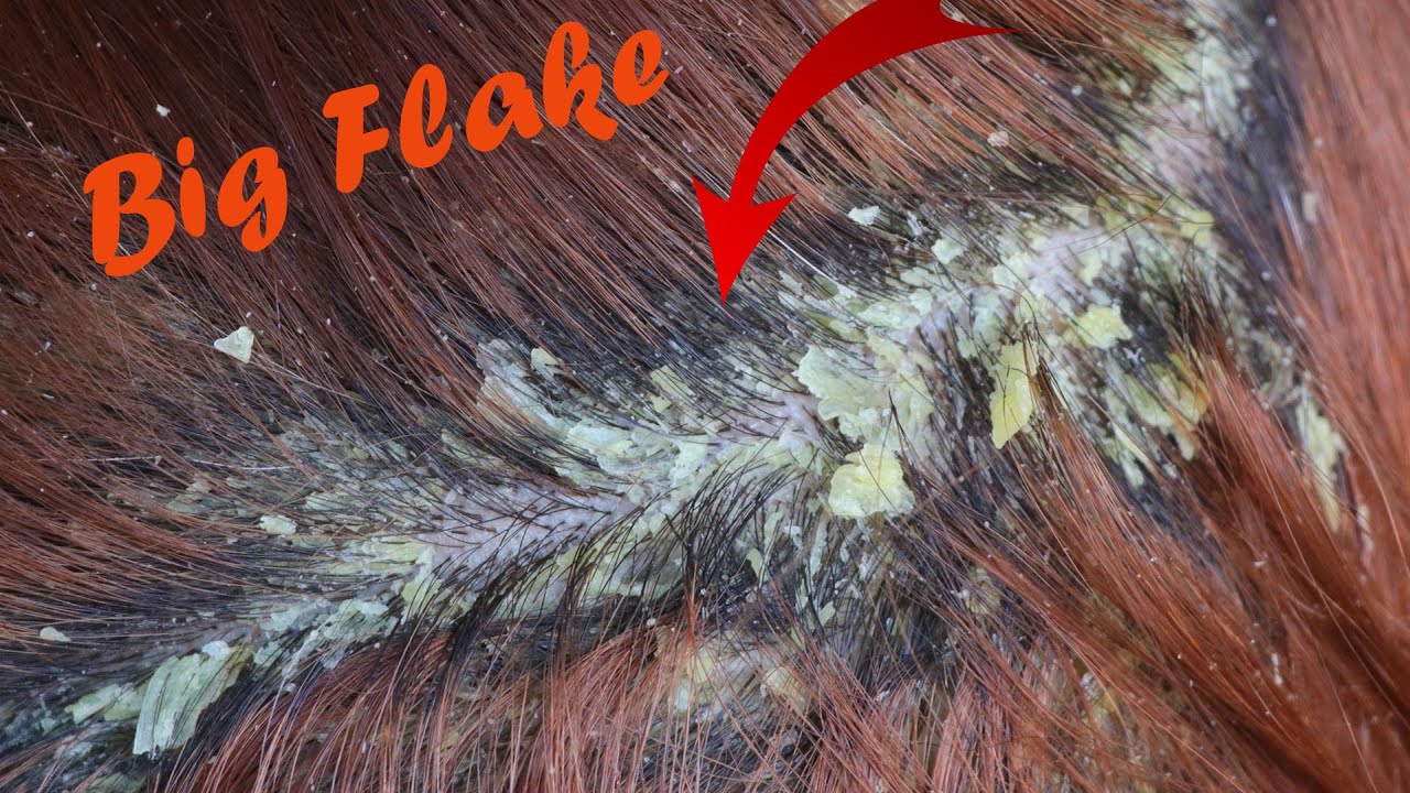 Scalp Scratch !! My Brother Big Flakes | Huge Dandruff Scratching #607 ...