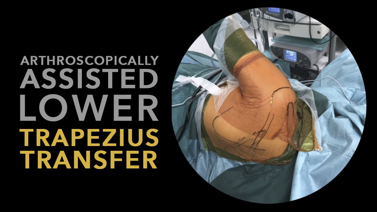 ARTHROSCOPICALLY ASSISTED LOWER TRAPEZIUS TRANSFER - YouTube