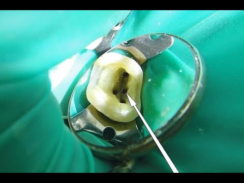 Лекция 2. ФУВ. Эндодонтия - YouTube
