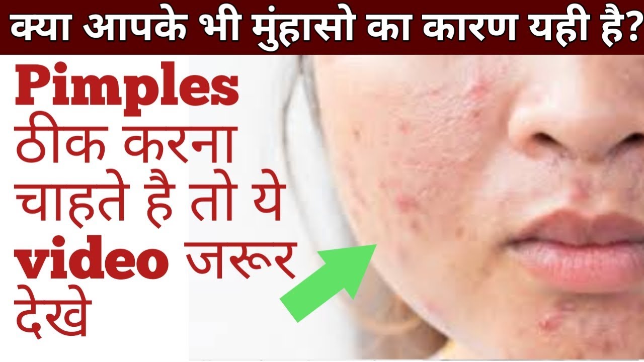 Pimples होने का असली कारण | Get permanent solution of pimples problem ...
