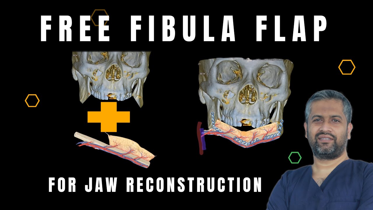 Jaw reconstruction. Fibula Flap Harvest. Management of Recurrent ...