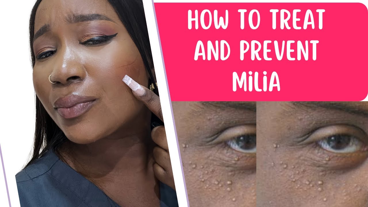 How to get rid of Milia and prevent them | Tiny white bumps | Acne look ...