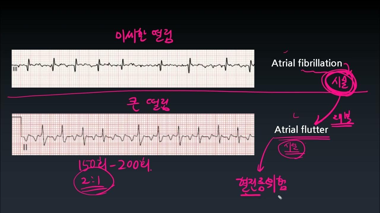 AF14 - 심방세동(atrial fibrillation)과 심방조동(atrial flutter) - YouTube