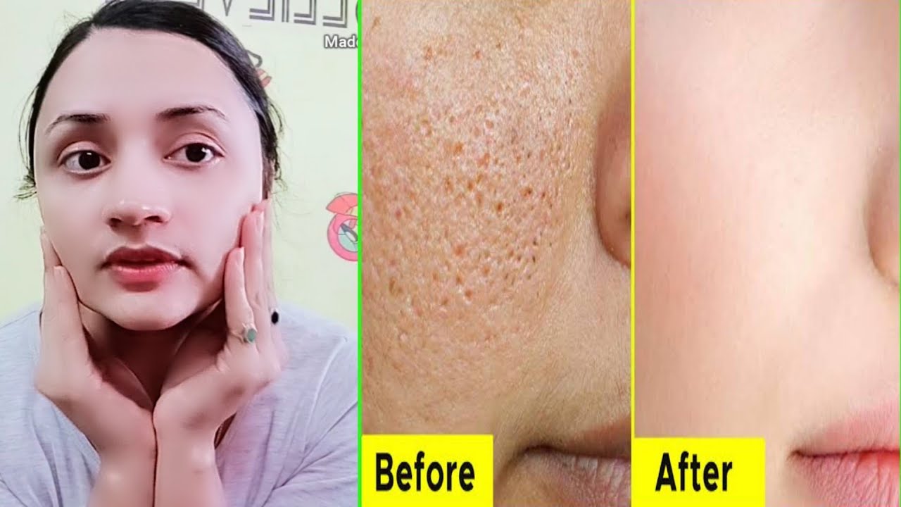 Open Pores से पाये हमेशा के लिए छुटकारा ओर पाये Crystal clear Flawless ...