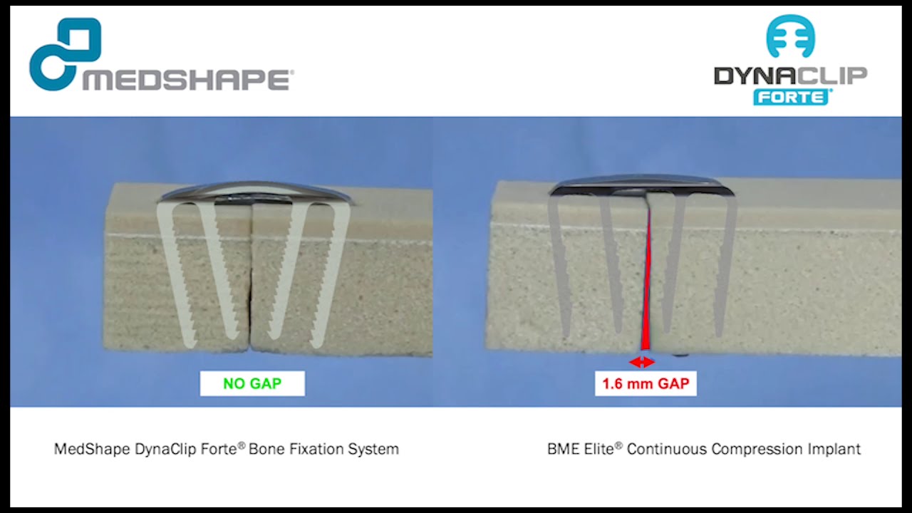 DynaClip Forte® Dynamic Compression to Reduce Plantar Gapping - YouTube