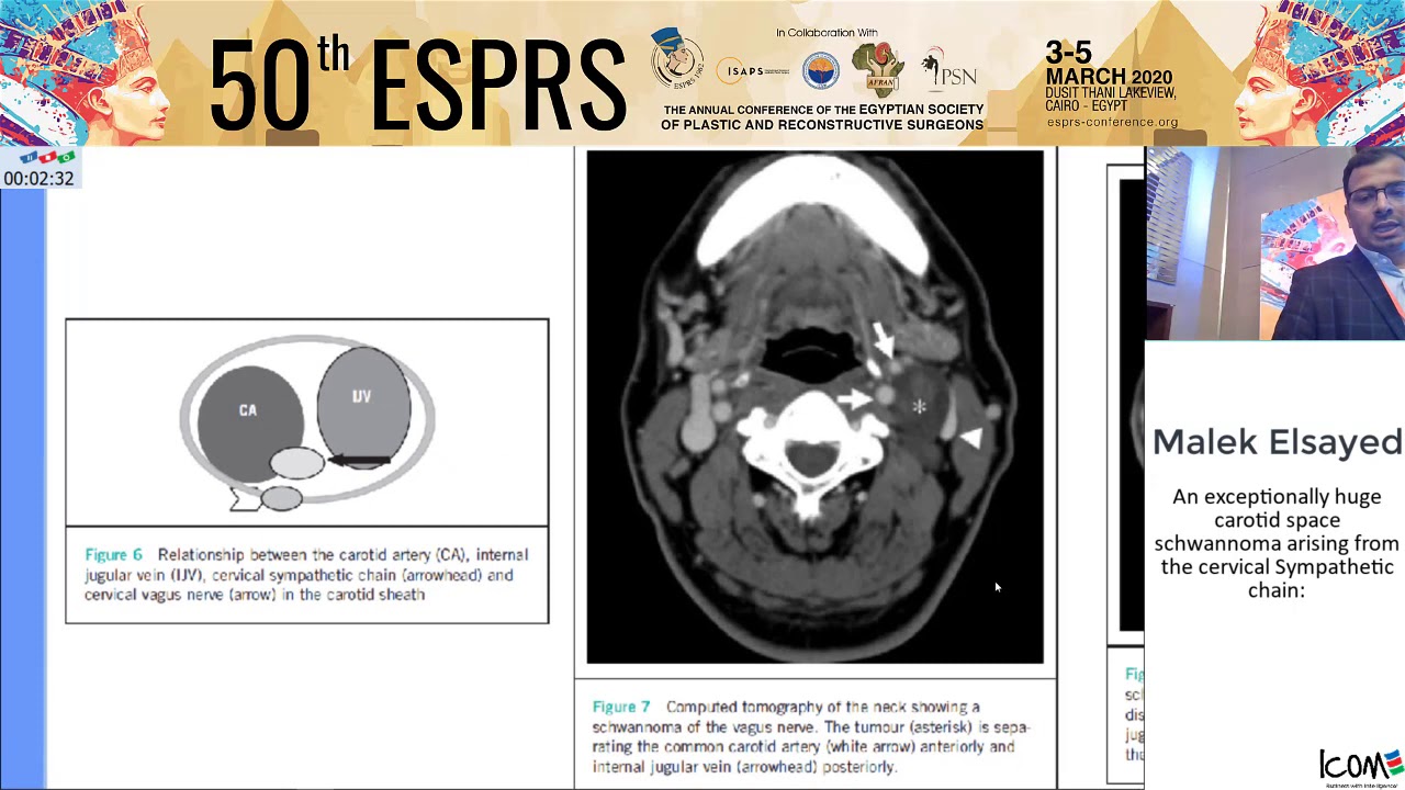 An exceptionally huge carotid space schwannoma arising from the ...