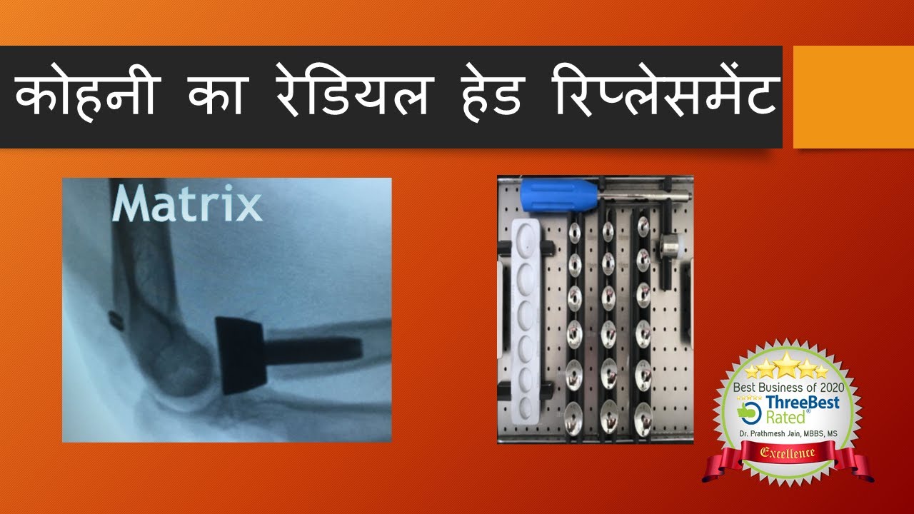 Radial Head Replacement Surgery ( Hindi) for Radial Head Fractures ...